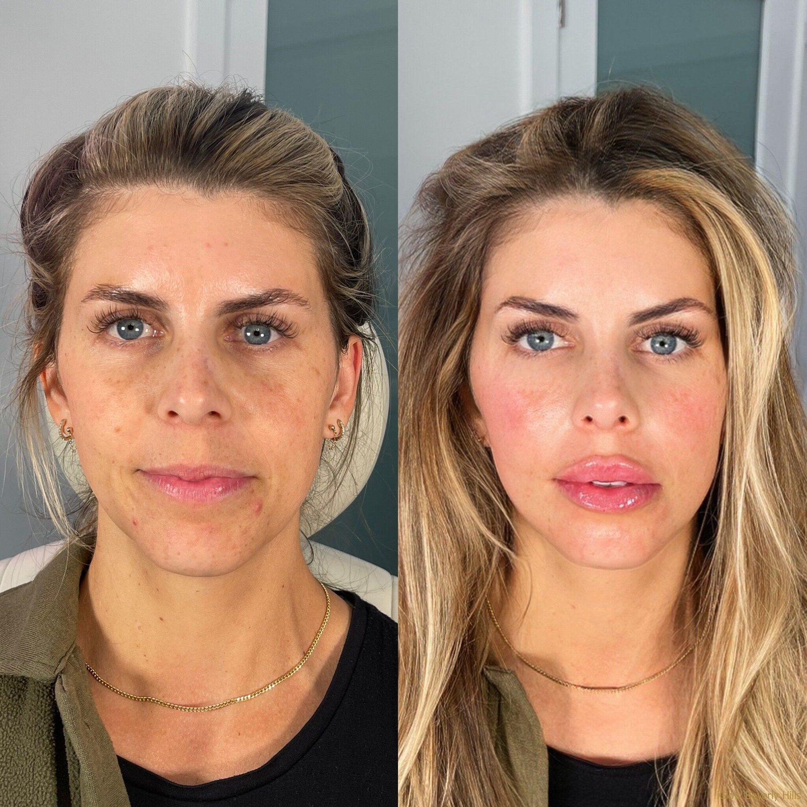 Dermal Fillers Los Angeles & Beverly Hills, CA